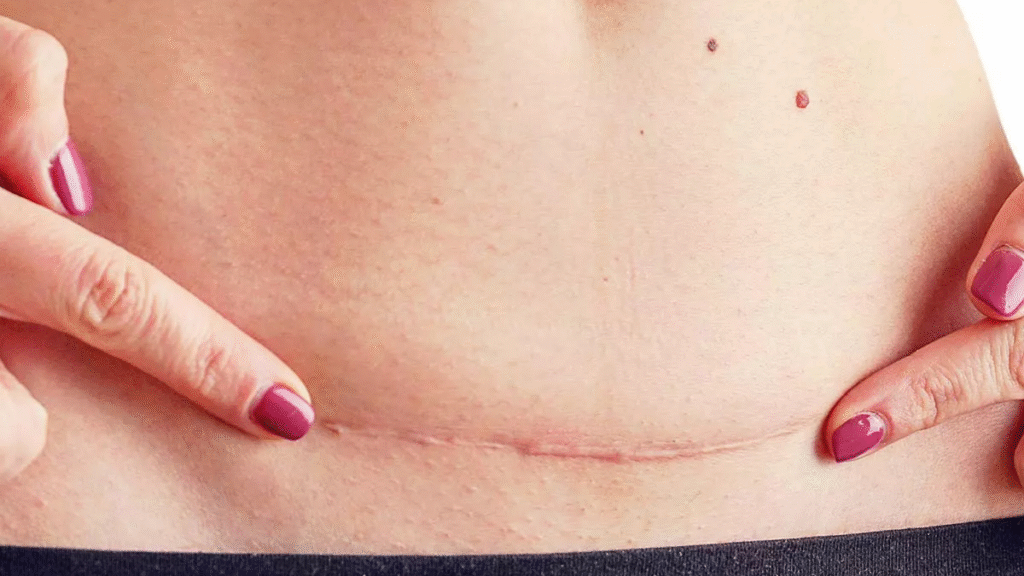C -Section Scar Infection! Symptoms, Causes And Prevention - Mom With Vibe